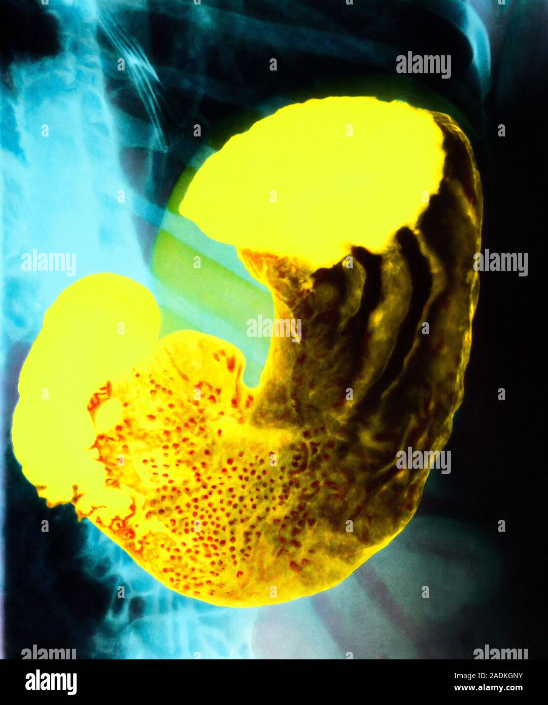 Healthy stomach. Coloured X-ray of the human stomach (yellow ...