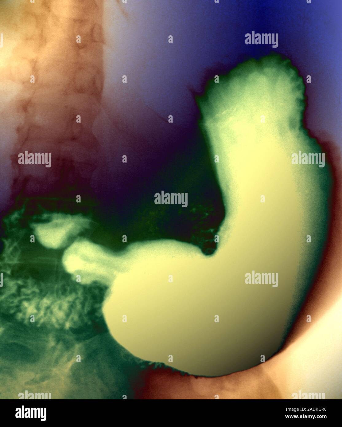 Stomach. Coloured X-ray of a healthy human stomach (yellow/green) with ...