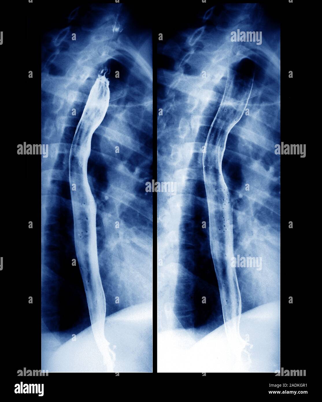 Oesophagus. Coloured X-ray of a barium meal being swallowed by a ...