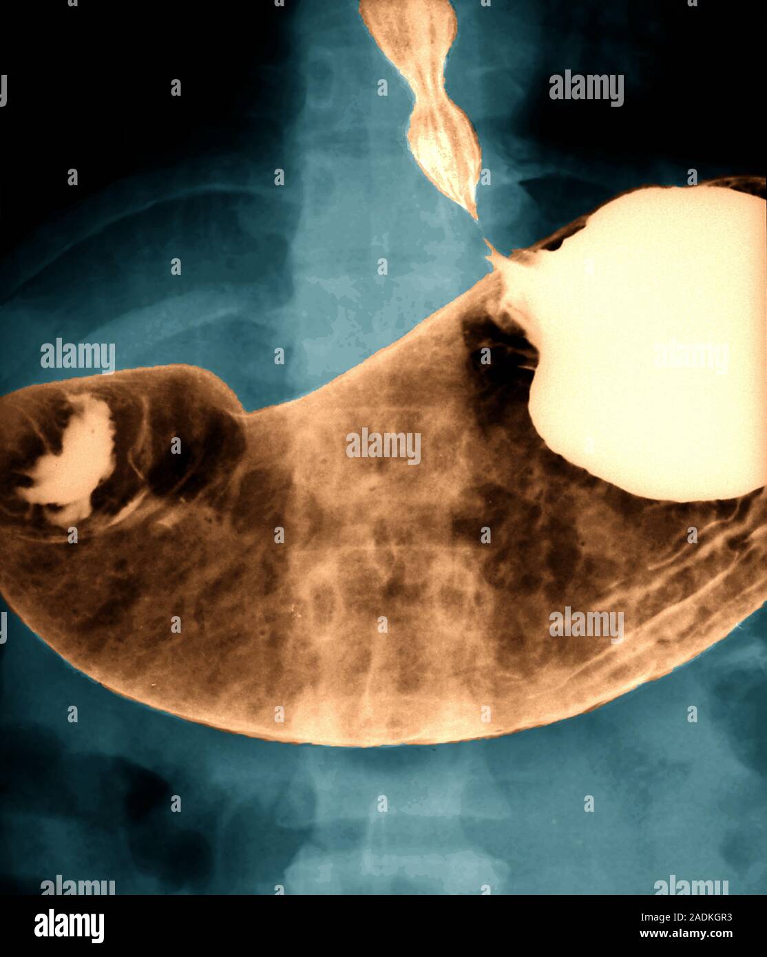 Stomach. Coloured X-ray of a barium meal (white, upper right) in a ...