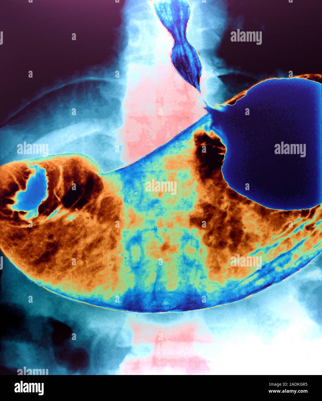 Stomach. Coloured X-ray of a barium meal (blue, upper right) in a ...