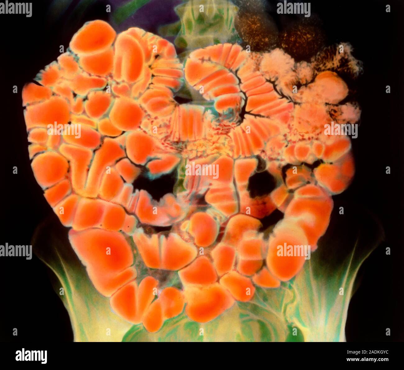 Small intestine. Coloured X-ray of the healthy small intestine of a ...