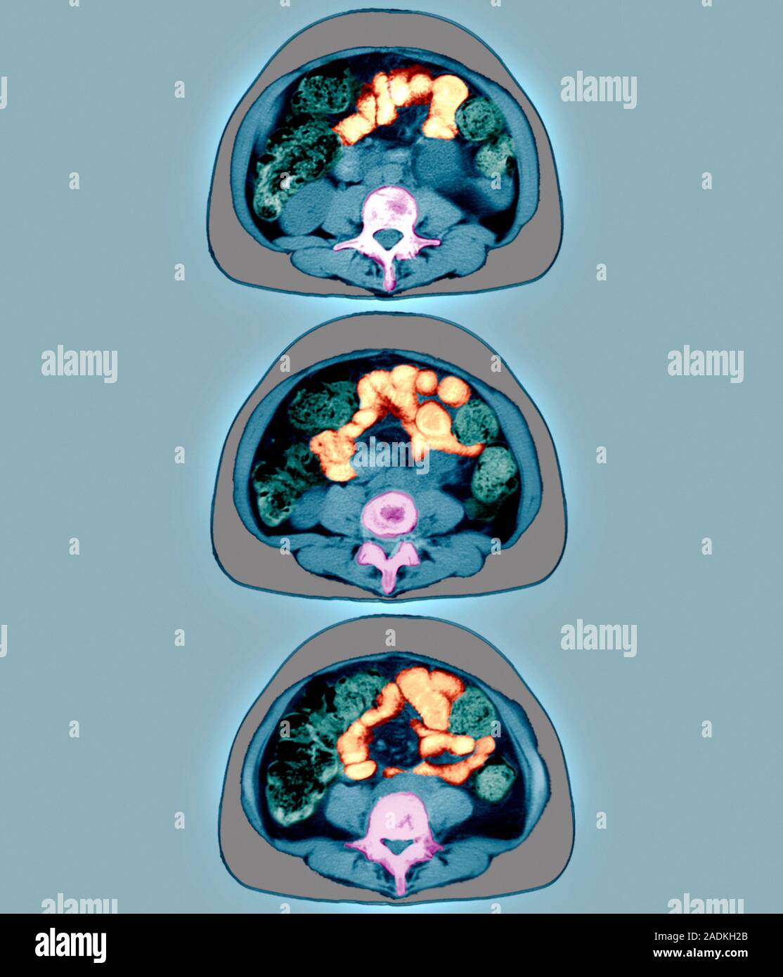 Intestines. Coloured computed tomography (CT) scans of three axial ...