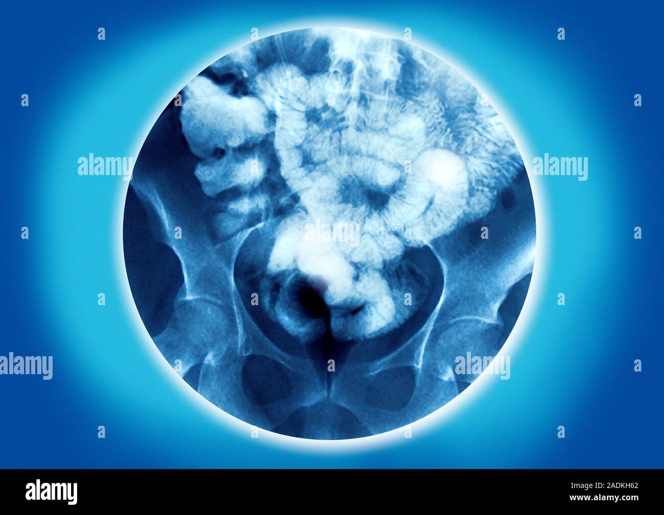 Healthy small intestine, coloured contrast barium enema X-ray. This X ...