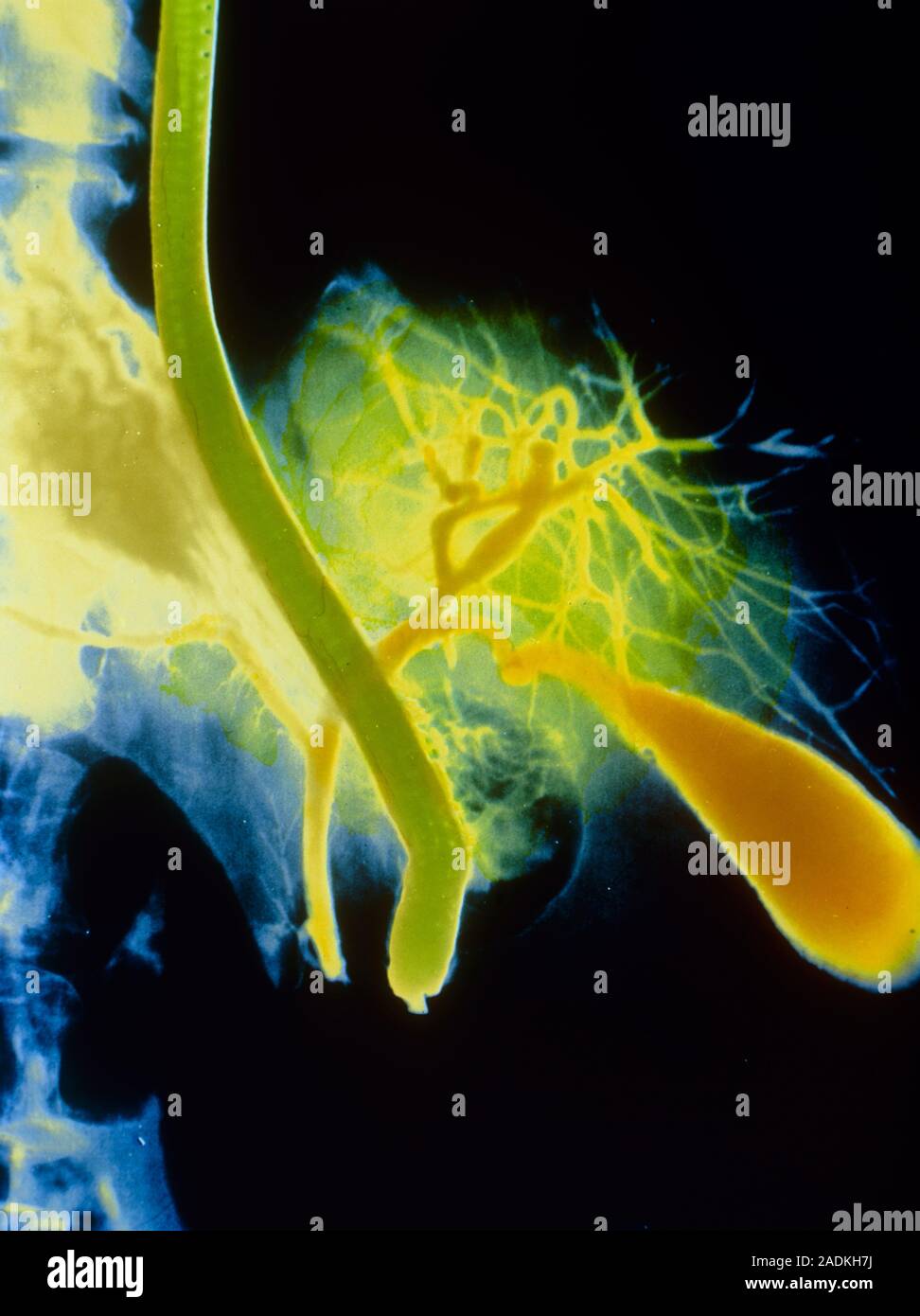 False-colour radiogram of the human gall bladder (balloon-like) and ...