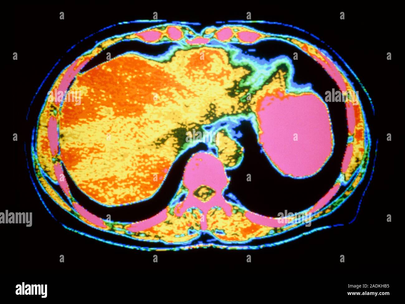 Liver and stomach. Coloured computed tomography (CT) scan of a transverse section of the abdomen ...