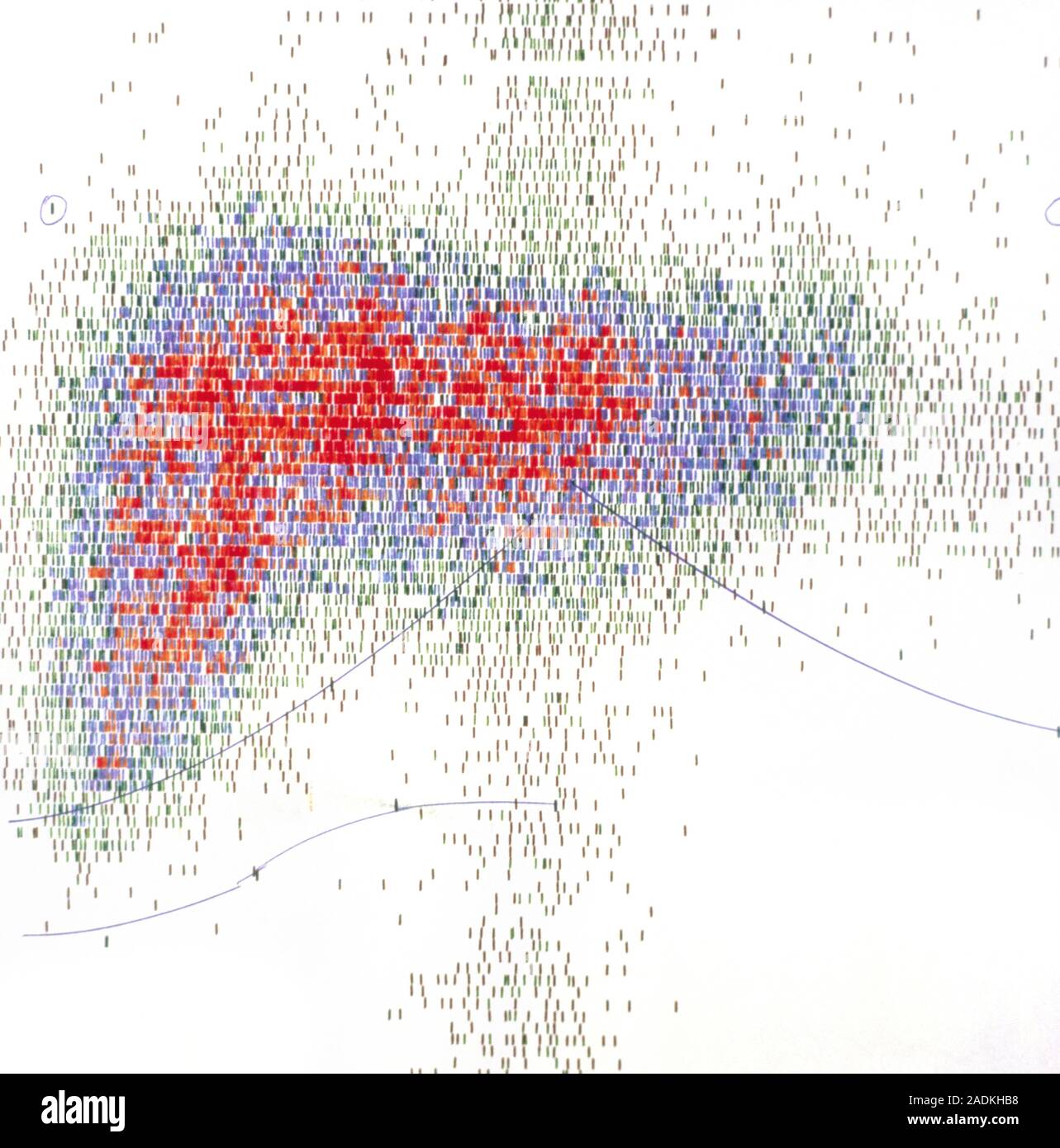 Coloured radionuclide or gamma scan of a normal liver (triangular ...