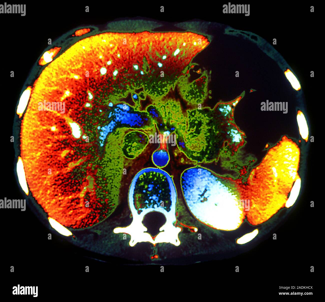 Liver. Coloured computed tomography (CT) scan of a section through the abdomen showing a healthy ...