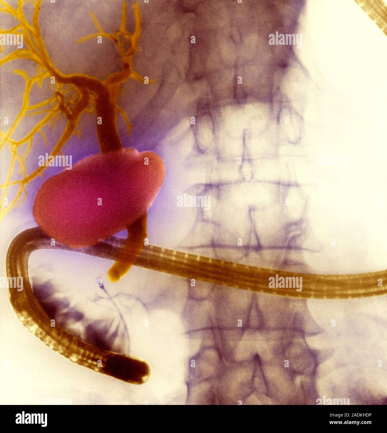 Gall bladder and bile ducts. Coloured X-ray of a healthy human gall ...