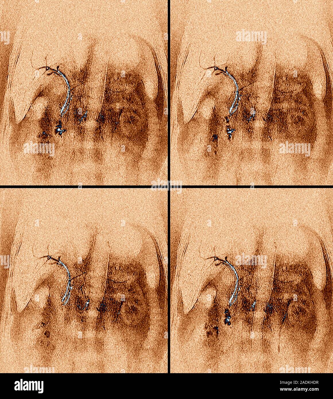 Digestive ducts. Coloured magnetic resonance imaging (MRI) scans of ...
