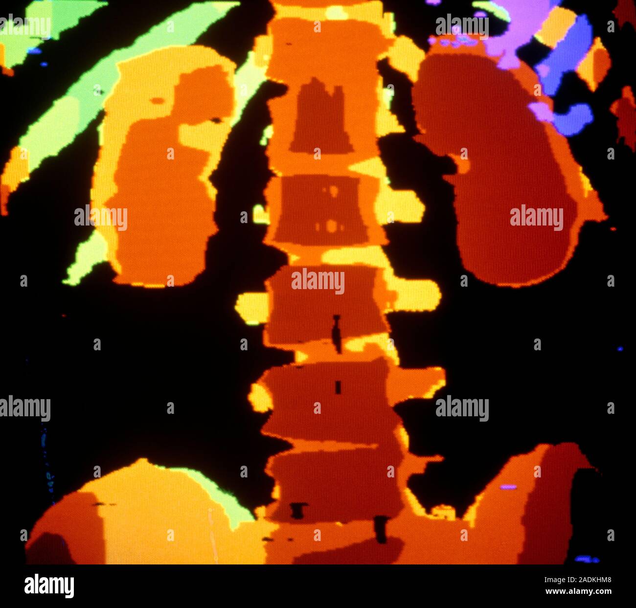 Kidney. Coloured computed tomography (CT) scan showing healthy kidneys ...