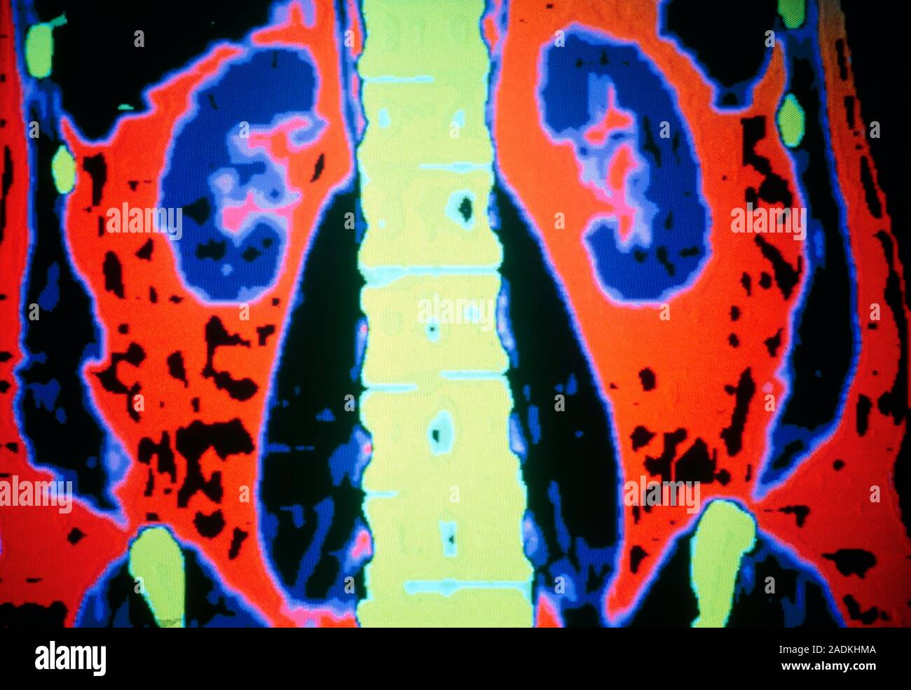 Kidney. Coloured computed tomography (CT) scan showing healthy kidneys ...