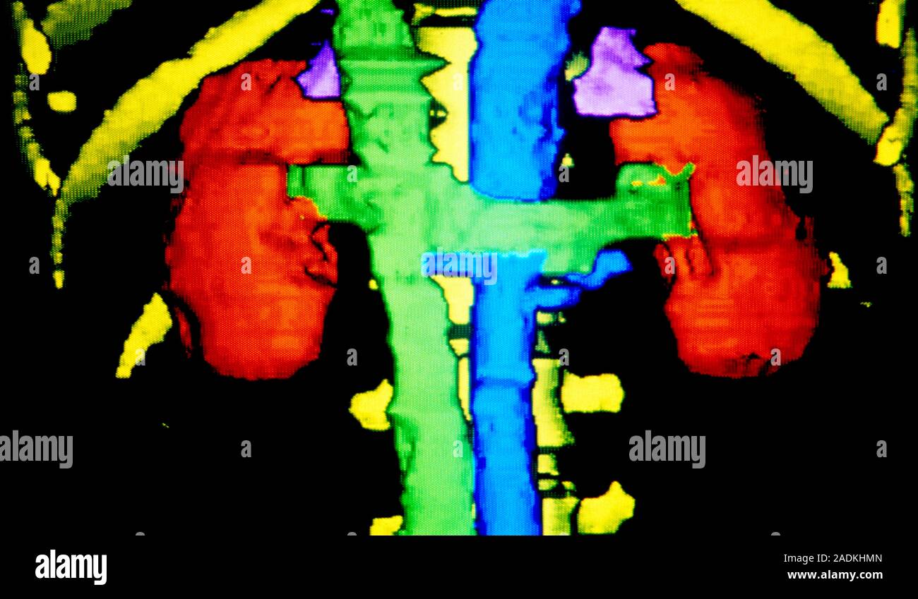 Kidneys. Coloured 3-D computed tomography (CT) scan of normal human ...
