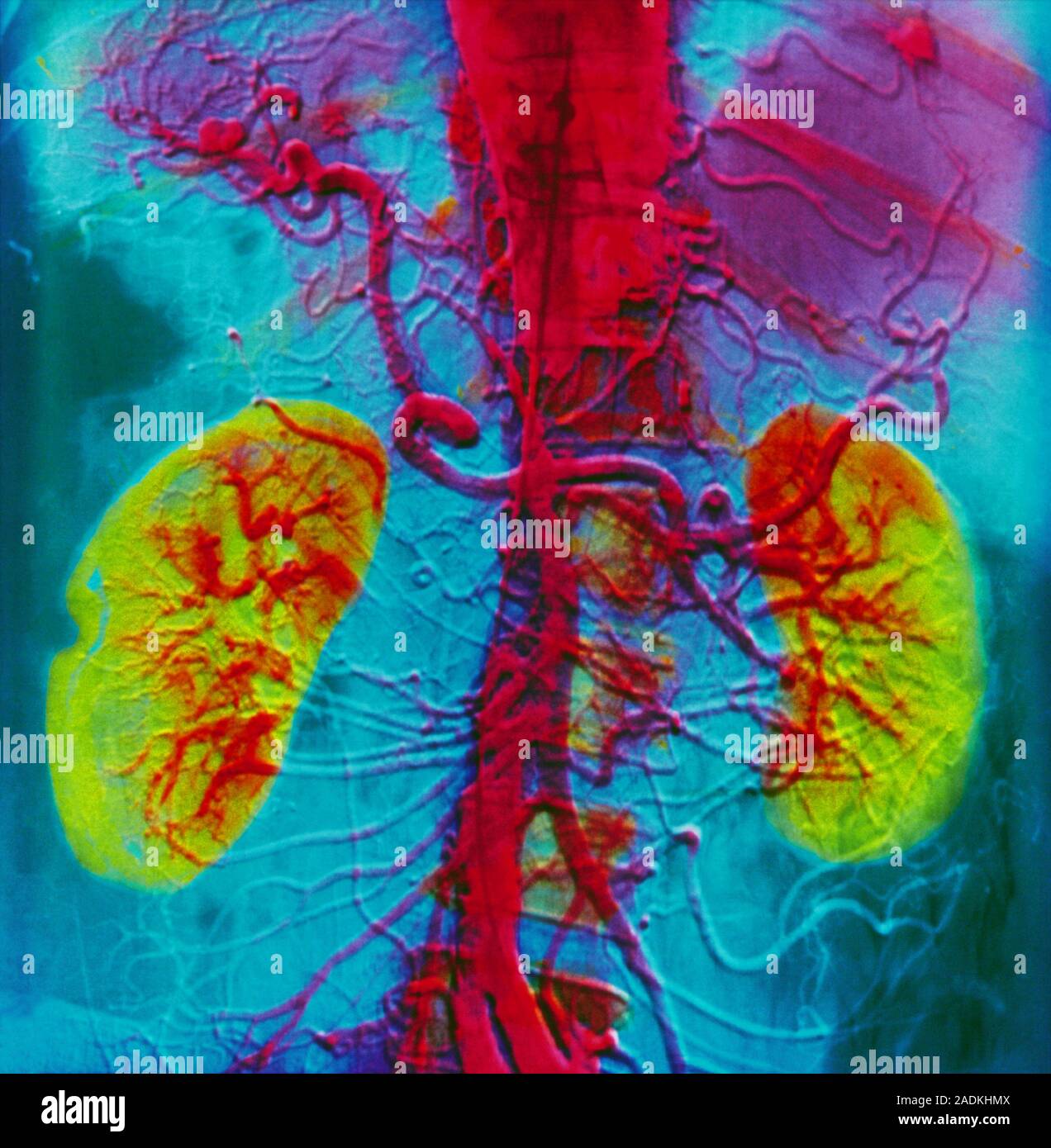 Kidney angiogram. Coloured angiogram showing the arteries that supply ...