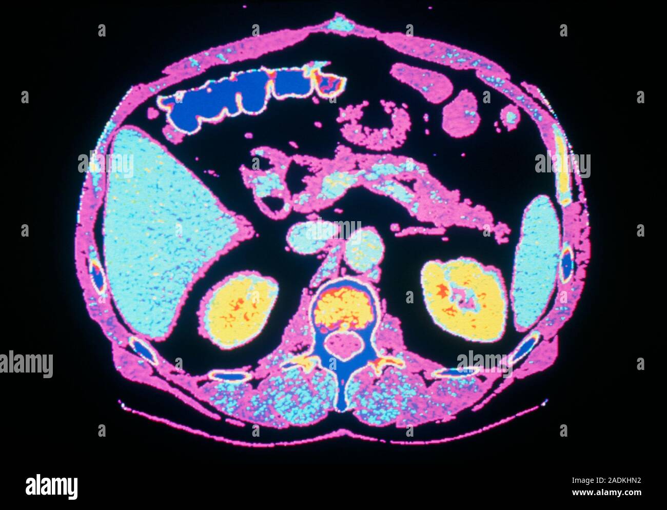 Kidneys in abdomen. Coloured computed tomography (CT) scan of the human abdomen, showing kidneys ...