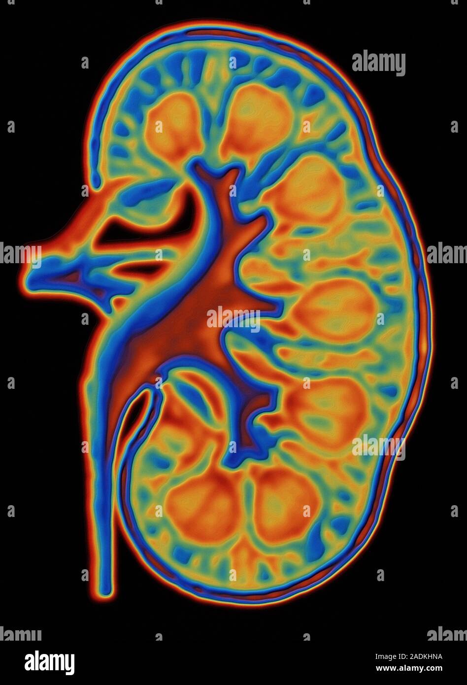 Kidney. Coloured Computed Tomography (CT) scan of a section through a ...