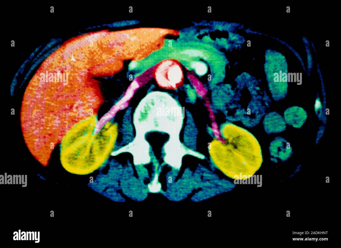 Healthy kidneys. Coloured computed tomography (CT) scan of the human abdomen, showing kidneys ...