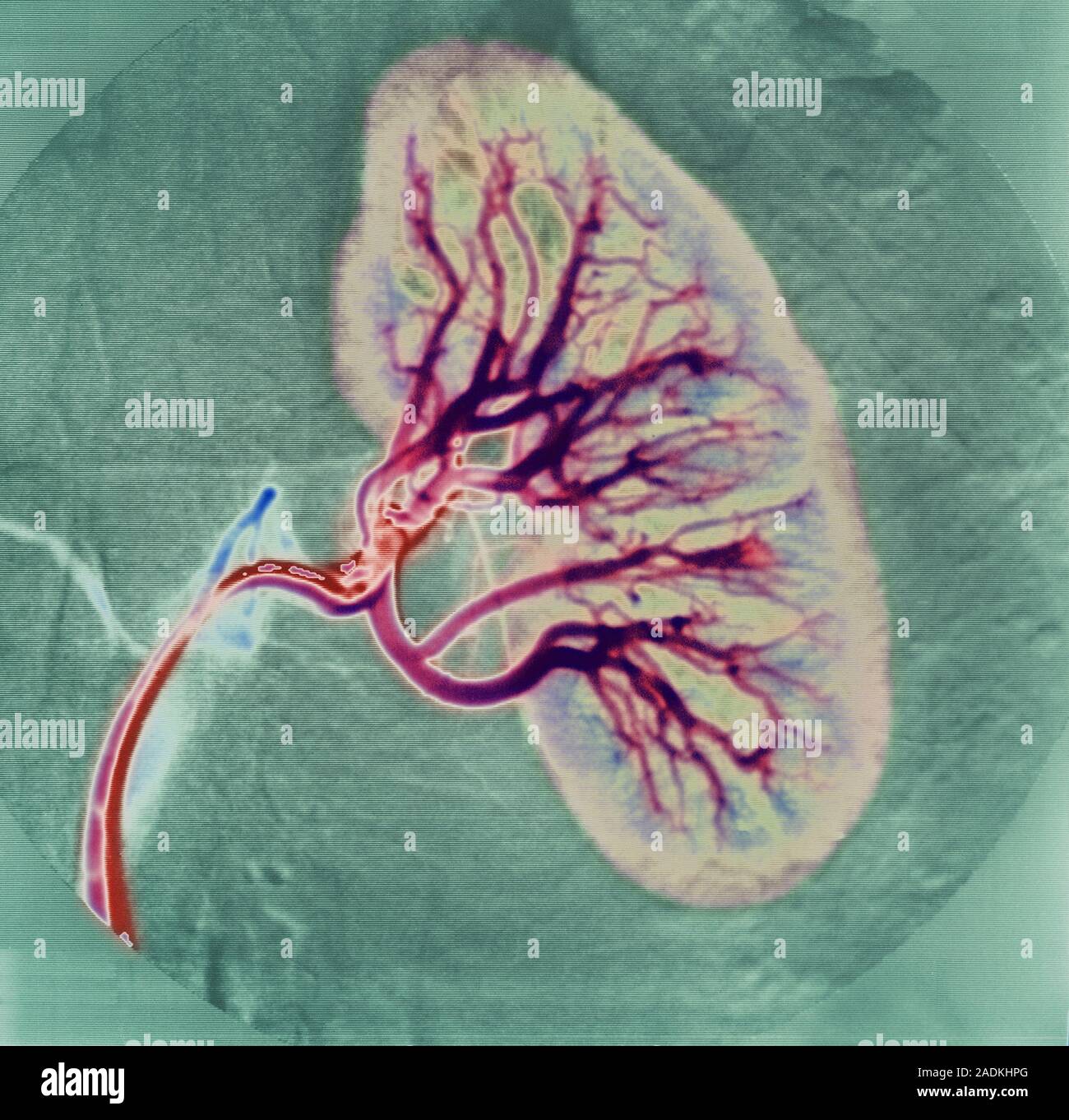 Kidney blood supply. Coloured angiogram (X-ray) showing the blood ...