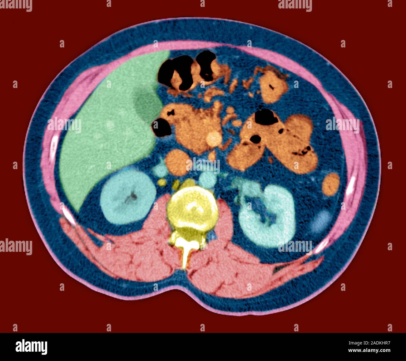 Normal kidneys. Coloured axial (horizontal) CT (computed tomography ...