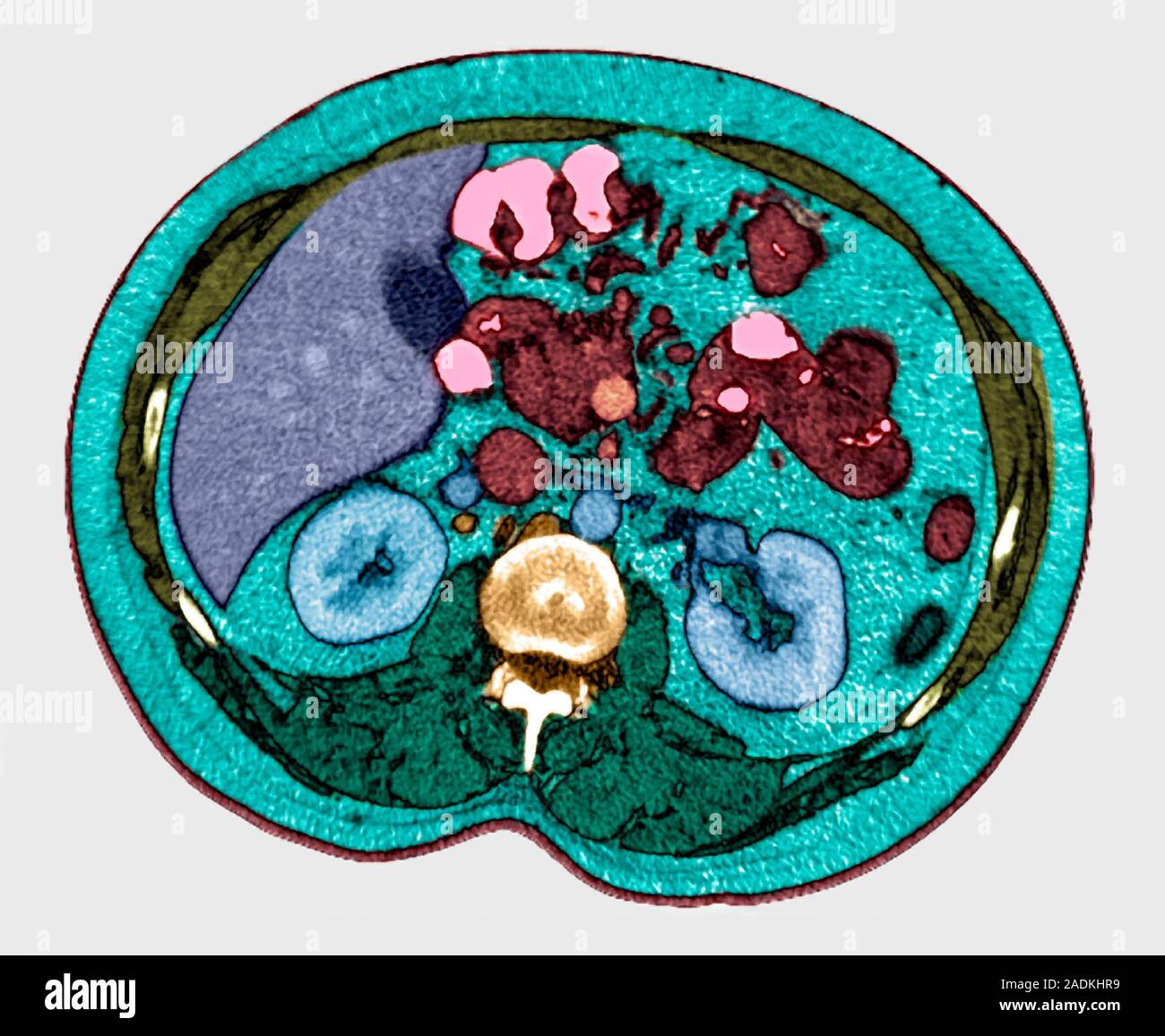 Normal kidneys. Coloured axial (horizontal) CT (computed tomography ...