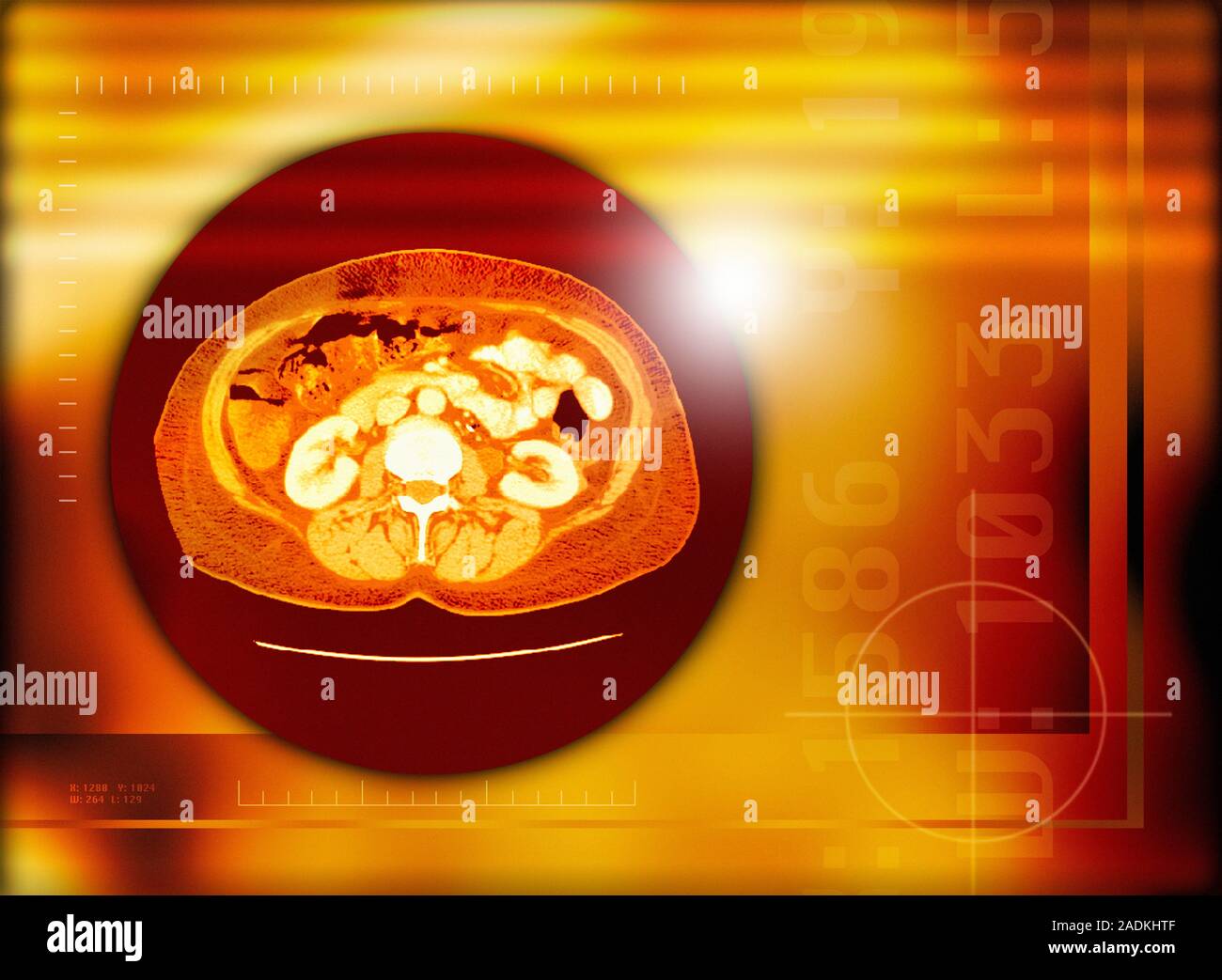 Kidneys. Coloured axial computed tomography (CT) scan of the abdomen at ...