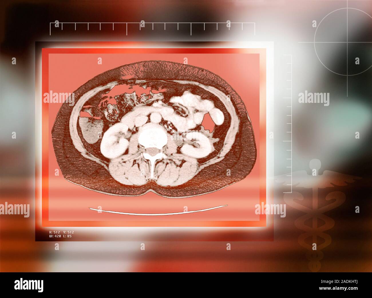 Healthy kidneys, coloured computed tomography (CT) scan. The kidneys ...
