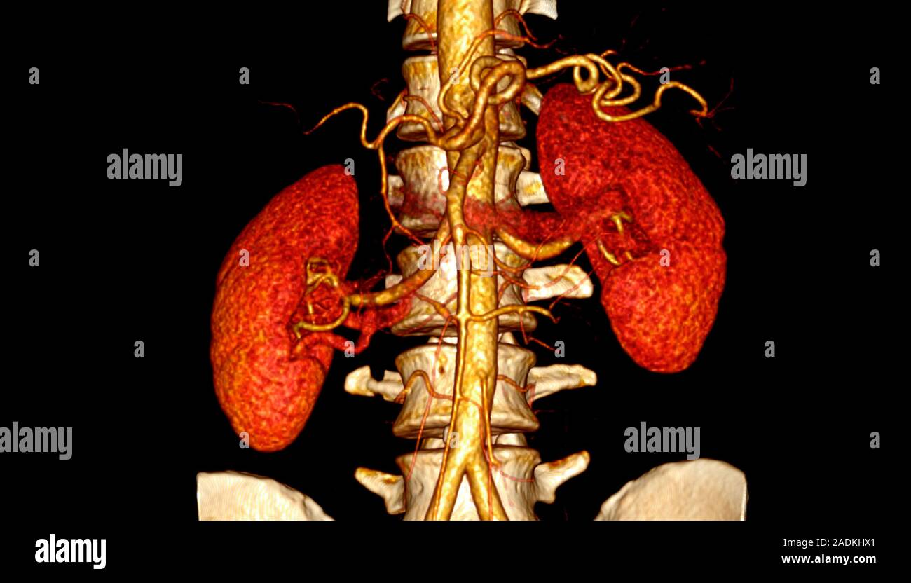 Kidneys, CT scan. Coloured 3-D computed tomography (CT) scan of kidneys ...