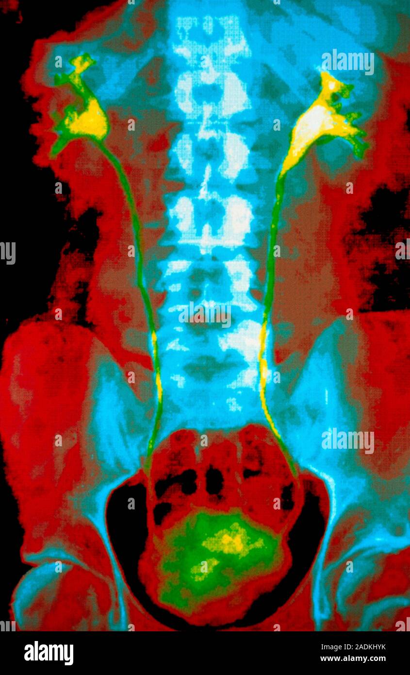 Urinary tract. Coloured Intra-Venous Urogram (IVU) X-ray image of the ...