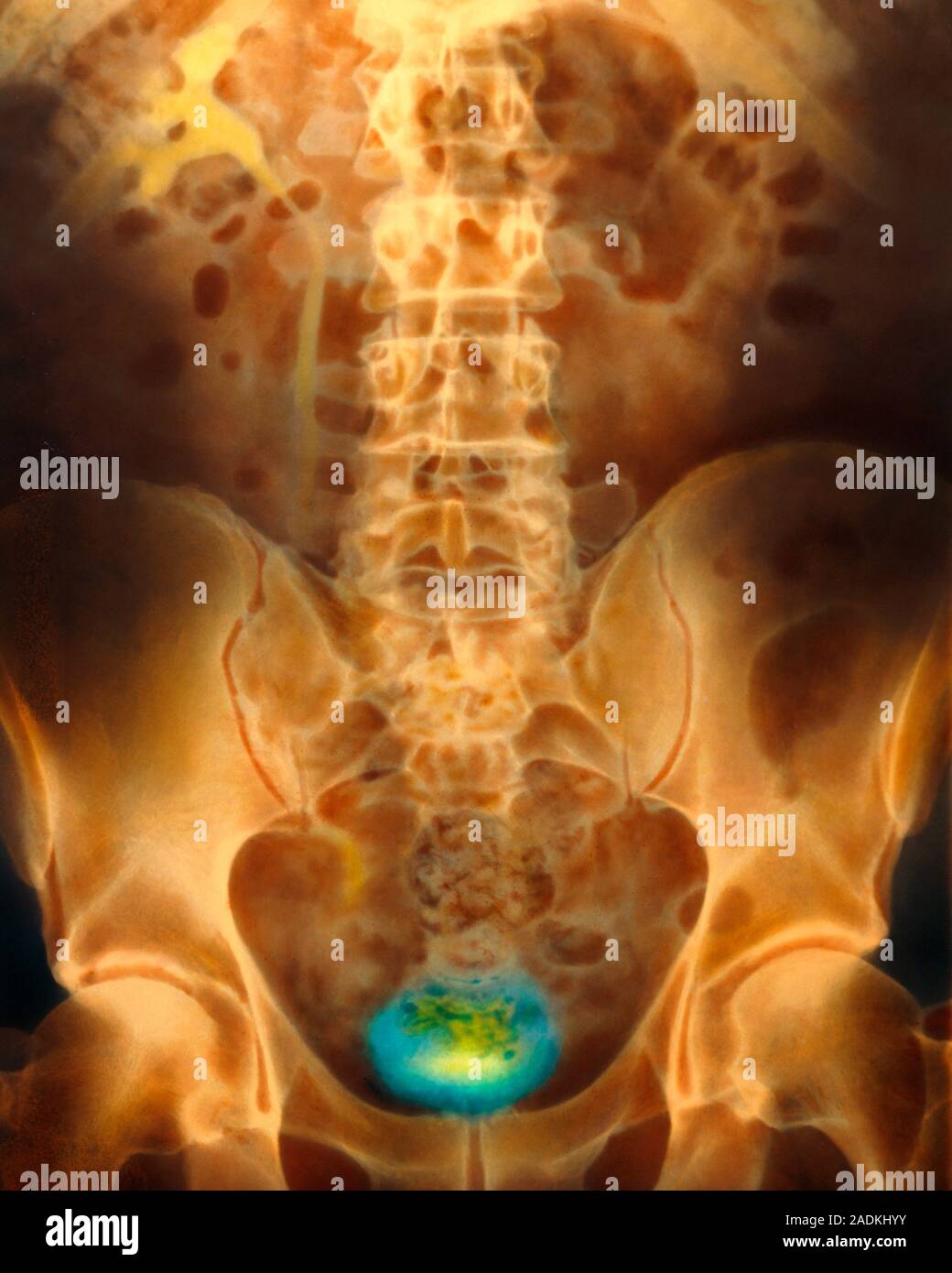 Empty bladder. Coloured X-ray urogram of the human abdomen, showing an ...