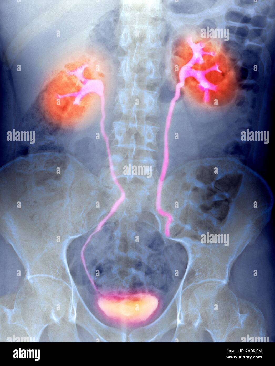 Urinary system. Coloured intravenous urogram (IVU) X-ray image of the ...
