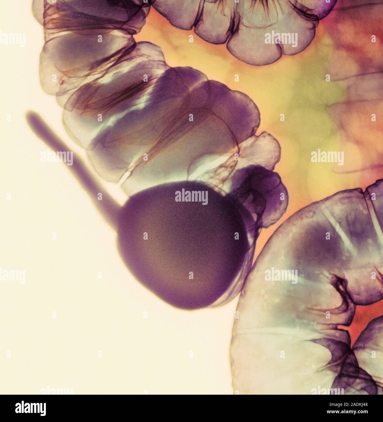 Healthy appendix. Coloured X-ray of the human appendix and colon (large ...