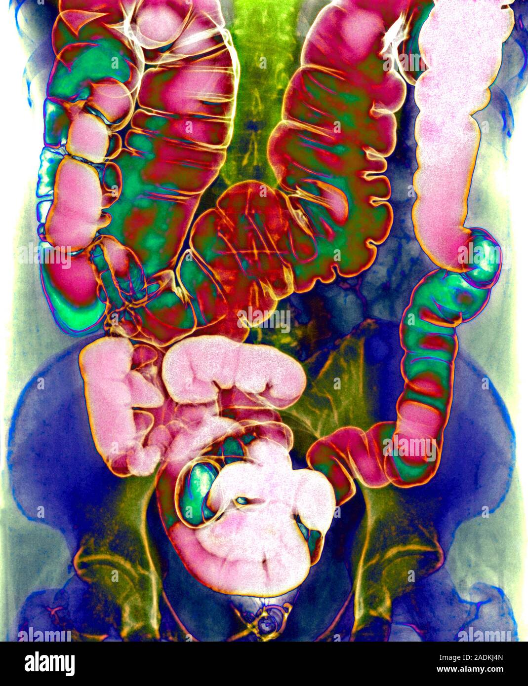 Large intestine. Coloured barium X-ray of the abdomen showing a healthy ...