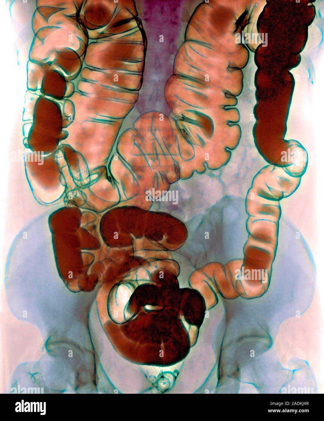Large intestine. Coloured barium X-ray of the abdomen showing a healthy ...