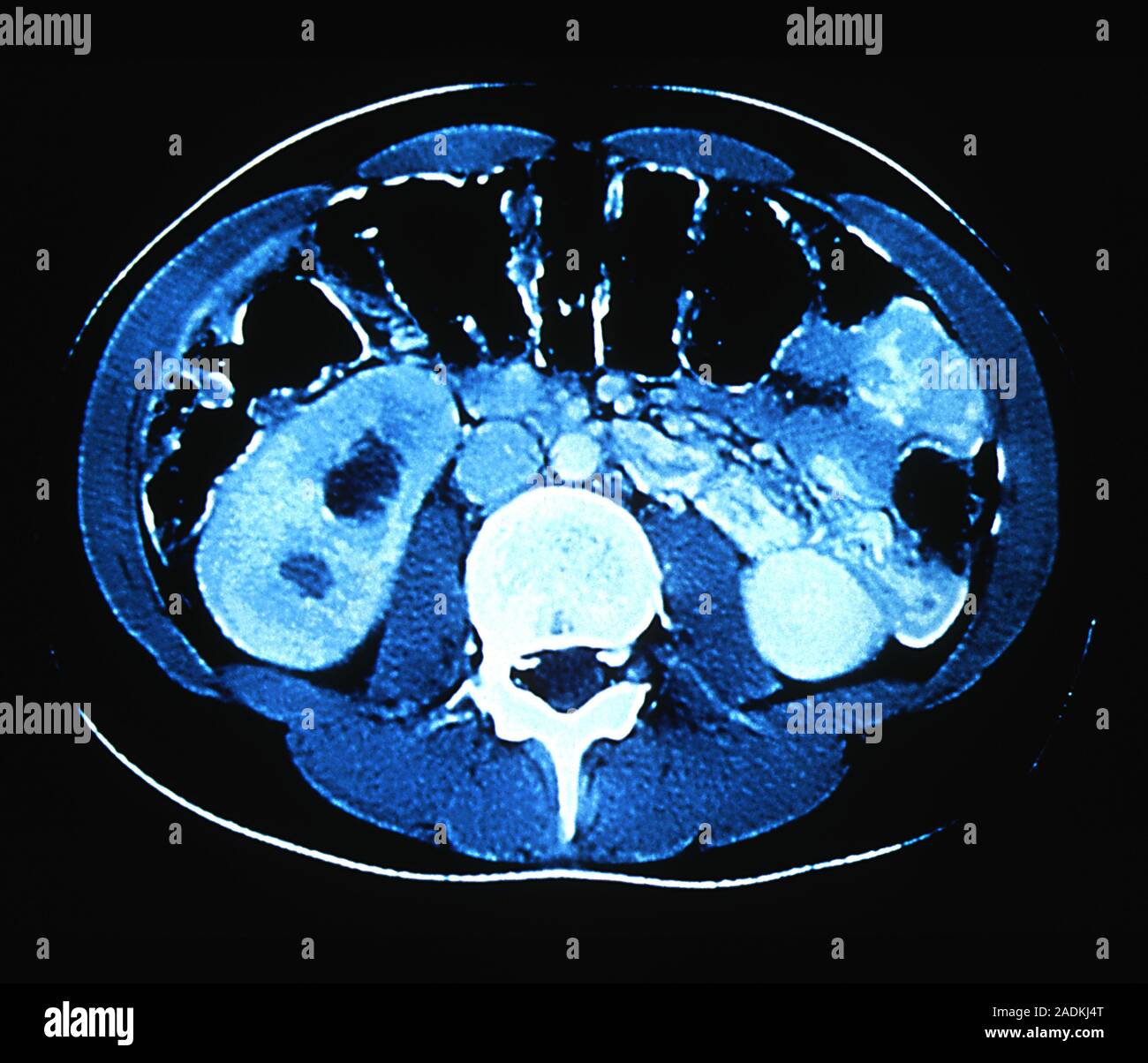 Transverse colon. Computed tomography (CT) scan of an axial section ...