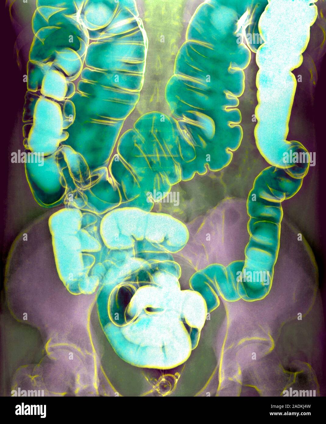 Large intestine. Coloured barium X-ray of the abdomen showing a healthy ...