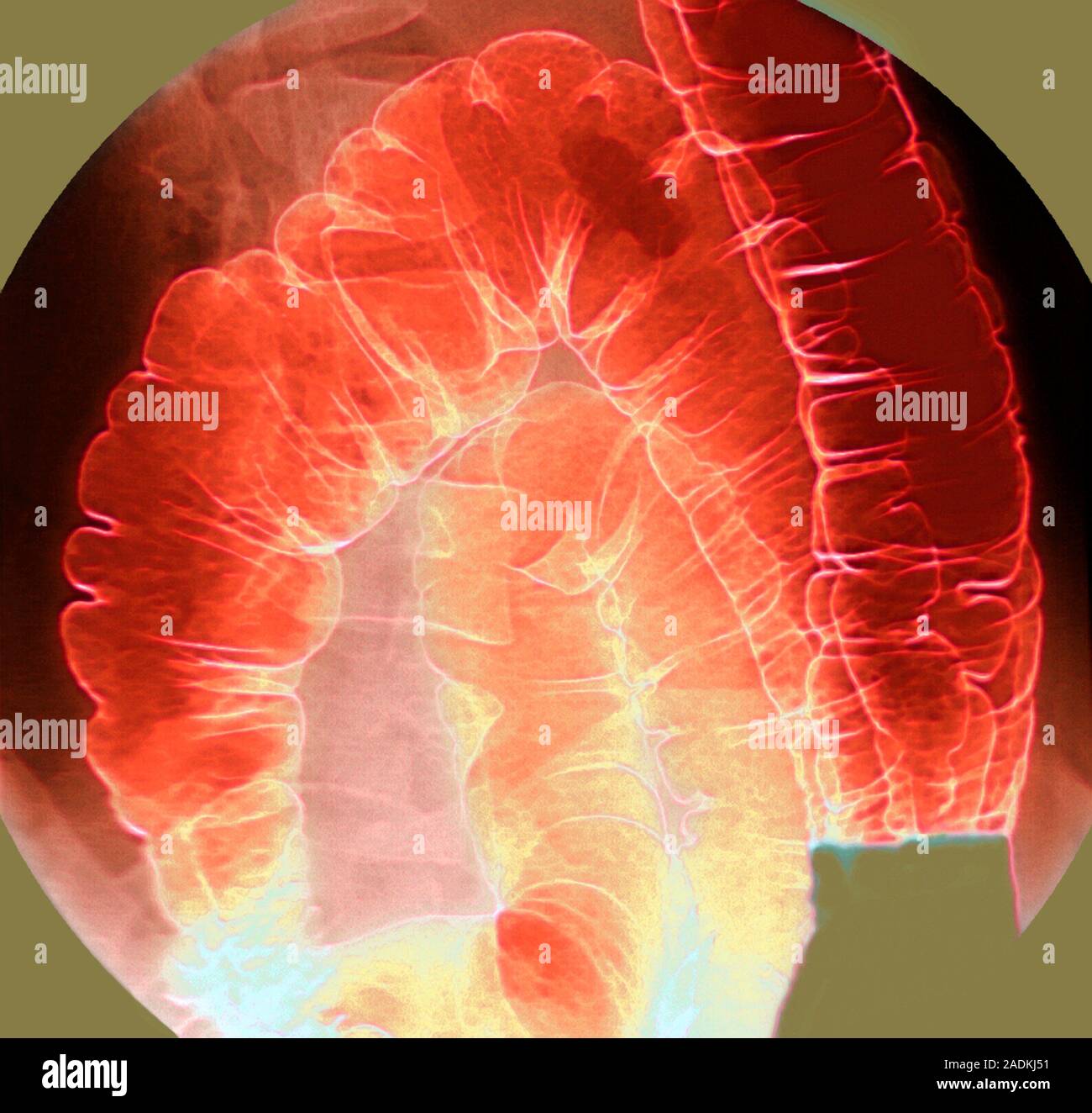 Large intestine. Coloured barium X-ray of a section of a healthy large ...