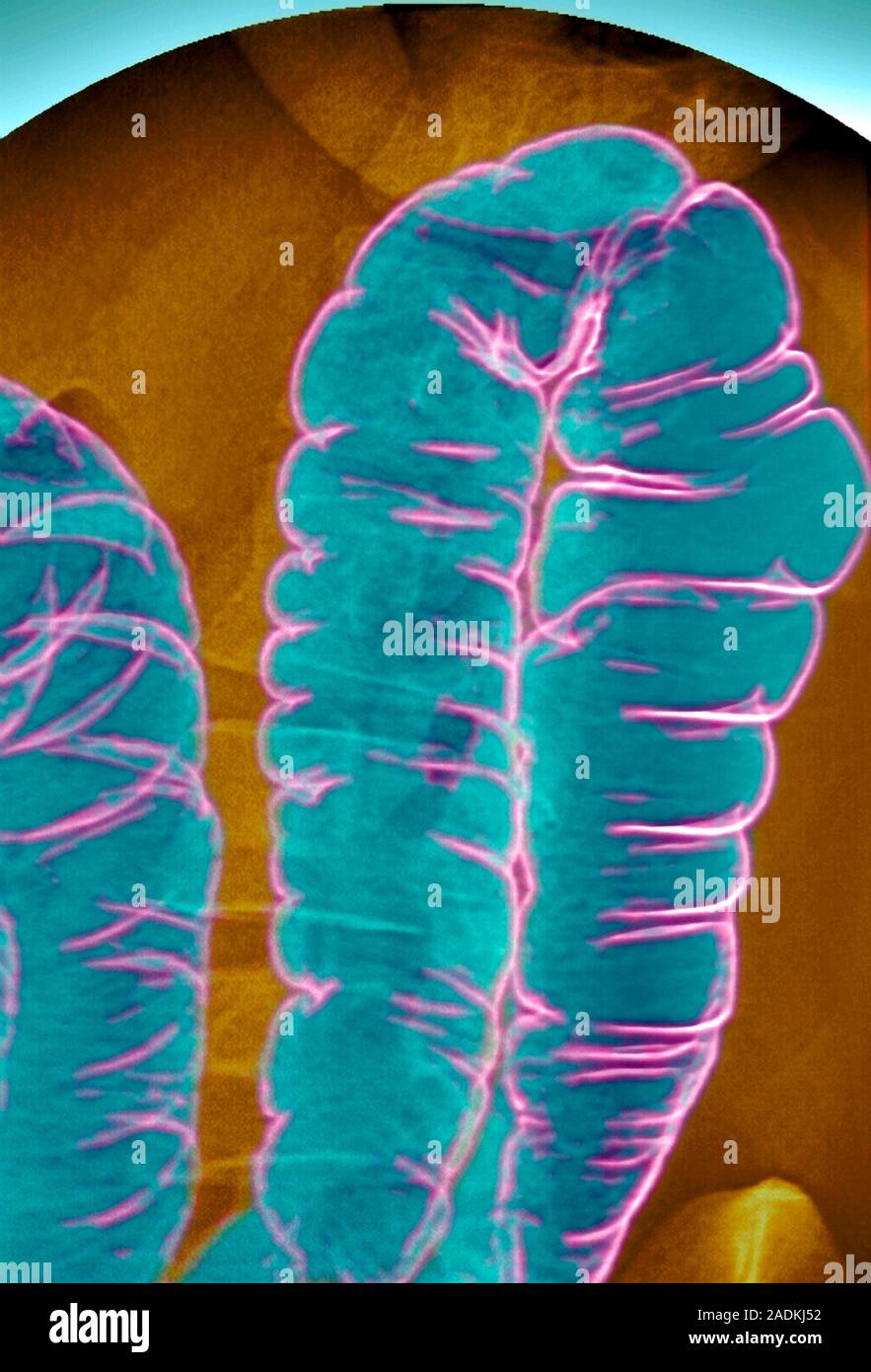 Large intestine. Coloured barium X-ray of a section of a healthy large ...