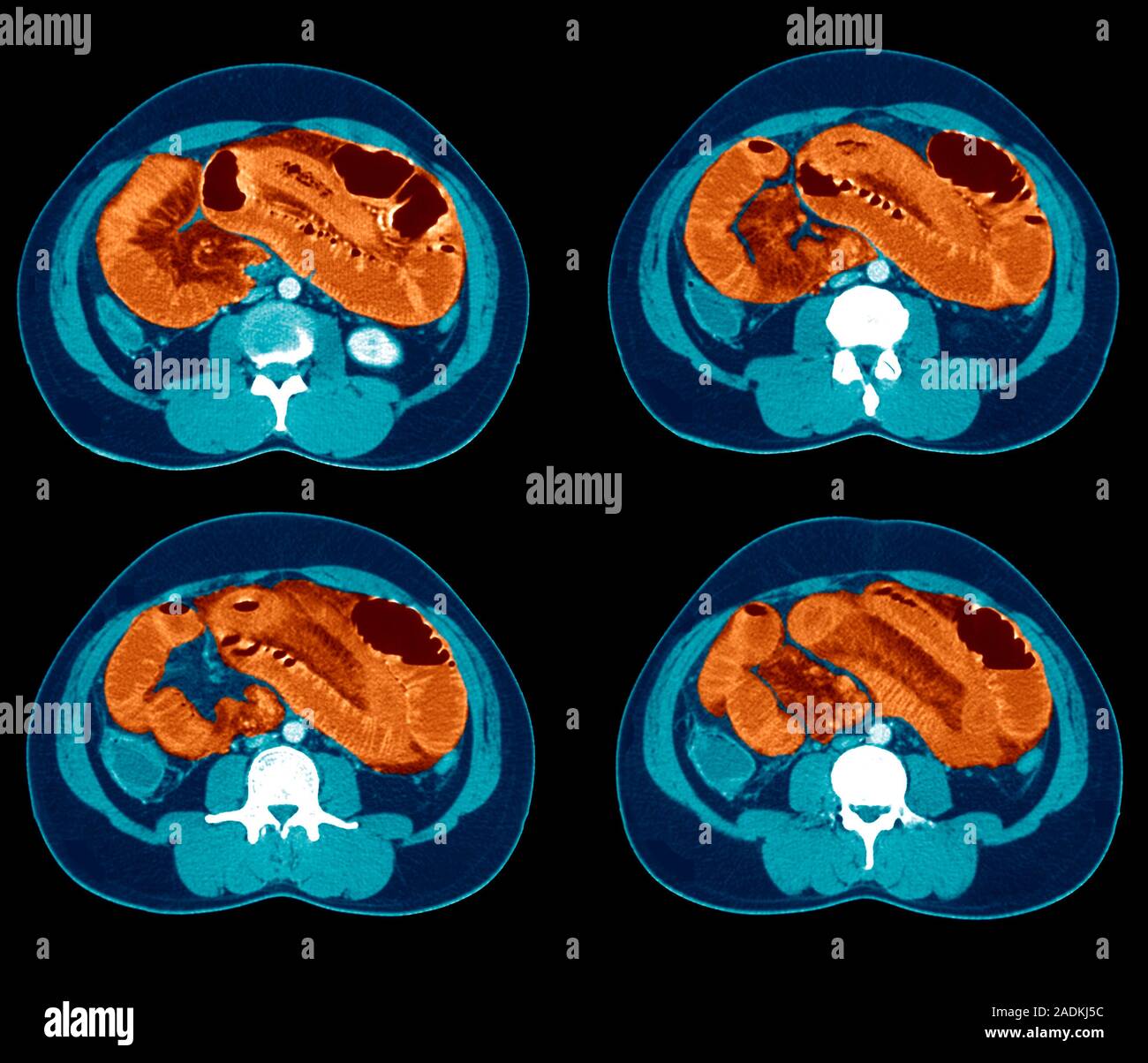 Healthy colon. Coloured computed tomography (CT) scan of axial sections ...