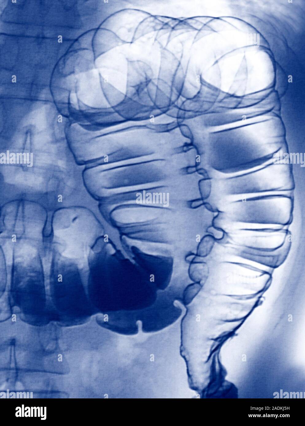 Large intestine, coloured X-ray. The large intestine constitutes the ...