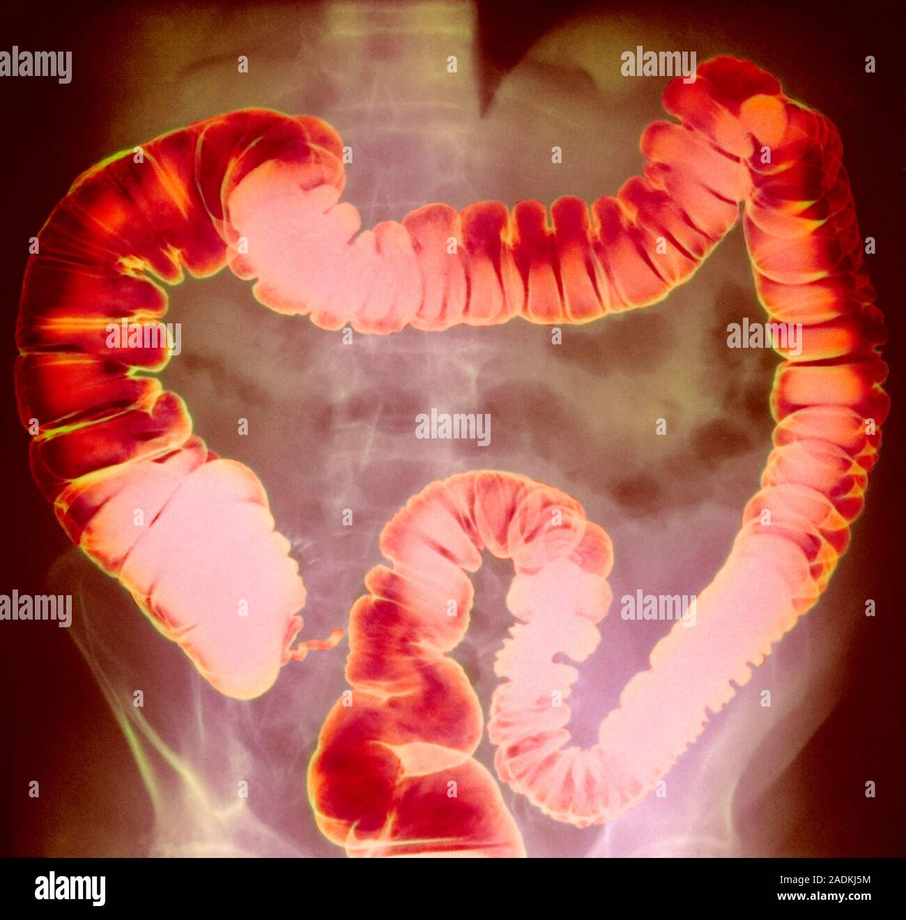 Large intestine. Coloured X-ray of the large intestine (colon) and ...