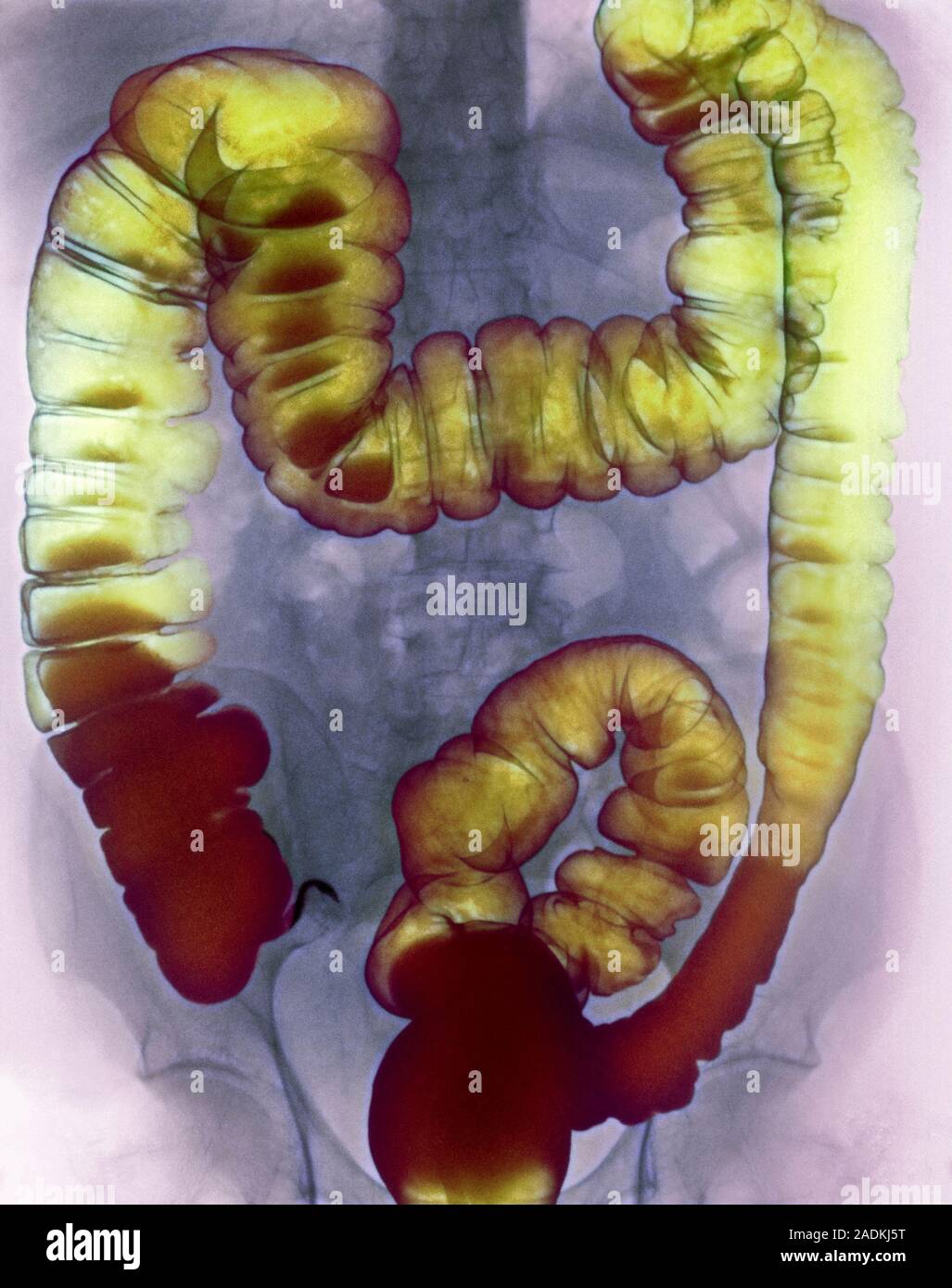 Large intestine. Coloured X-ray of the large intestine (colon) and ...