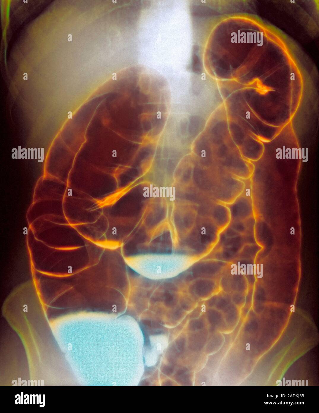 Large intestine. Double contrast coloured X-ray of the abdomen showing ...
