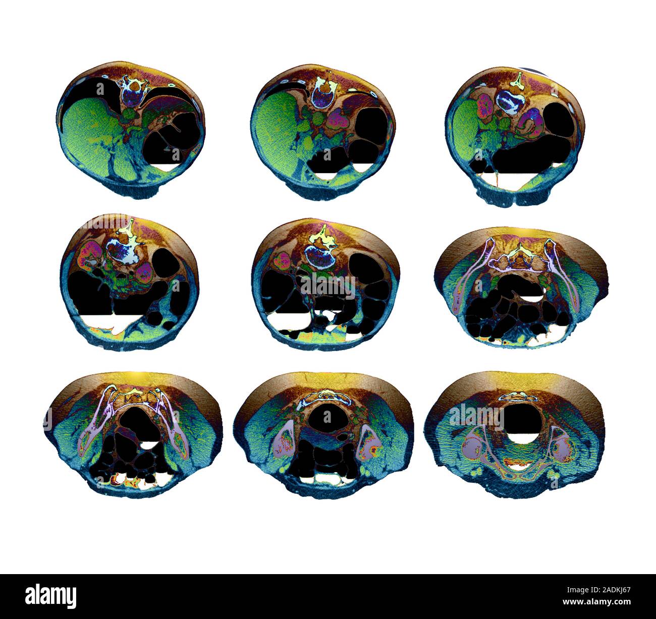 Large intestine. Coloured computer tomography (CT) scans of sections ...