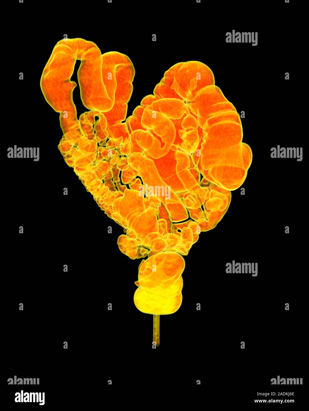 Large intestine, CT scan. Coloured 3-D computed tomography (CT) scan of ...