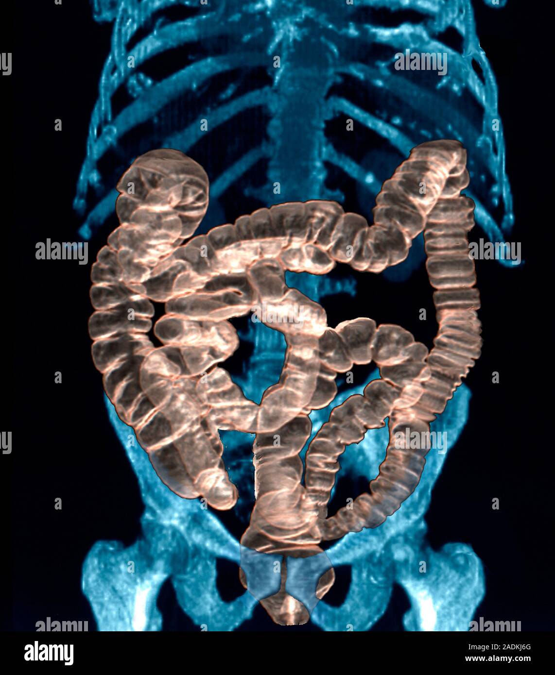Normal intestines. Coloured 3D computed tomography (CT) scan of the ...
