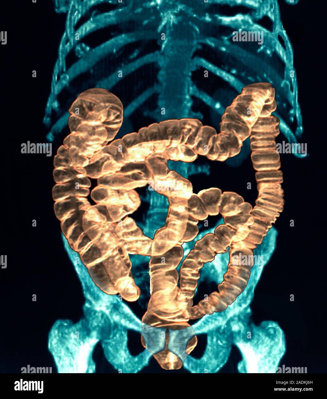 Normal intestines. Coloured 3D computed tomography (CT) scan of the ...
