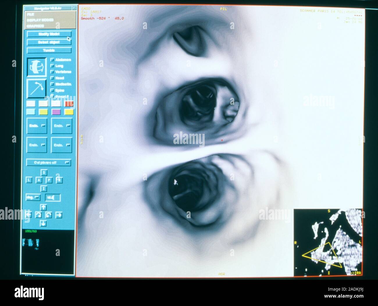 Lung bronchioles. Three-dimensional computed tomo- graphy (CT) scan of ...