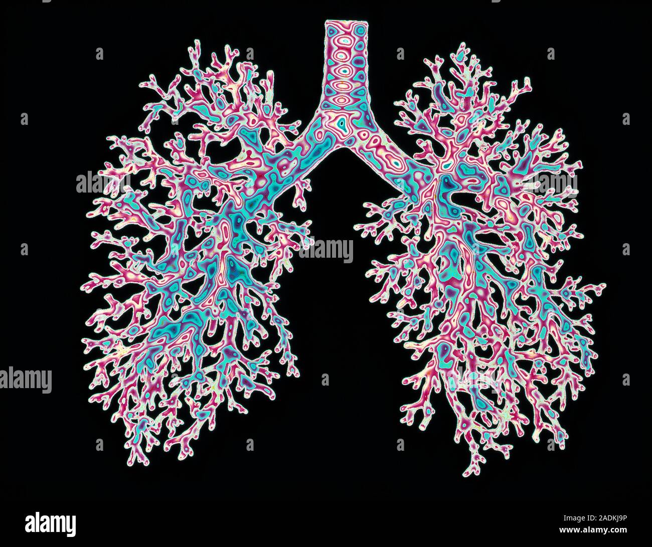 Lung airways. Computer-enhanced image of a resin cast of the airways in ...