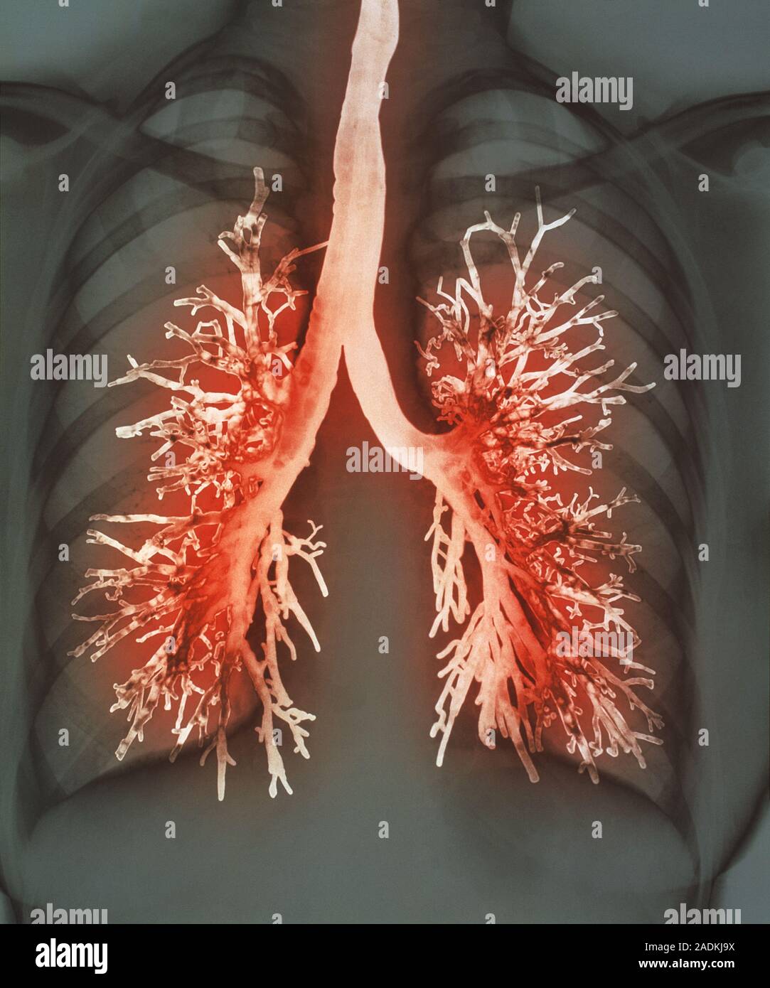 Lung airways. Coloured chest X-ray showing the healthy airways (red) of ...
