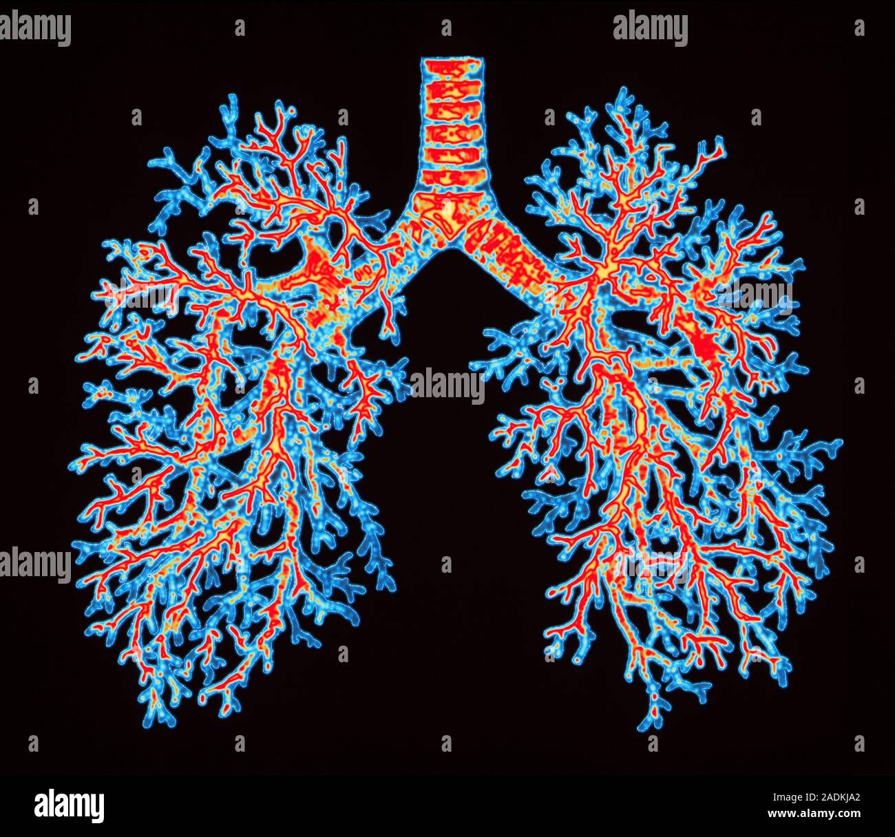 Lung airways. Computer-enhanced image of a resin cast of the airways in ...